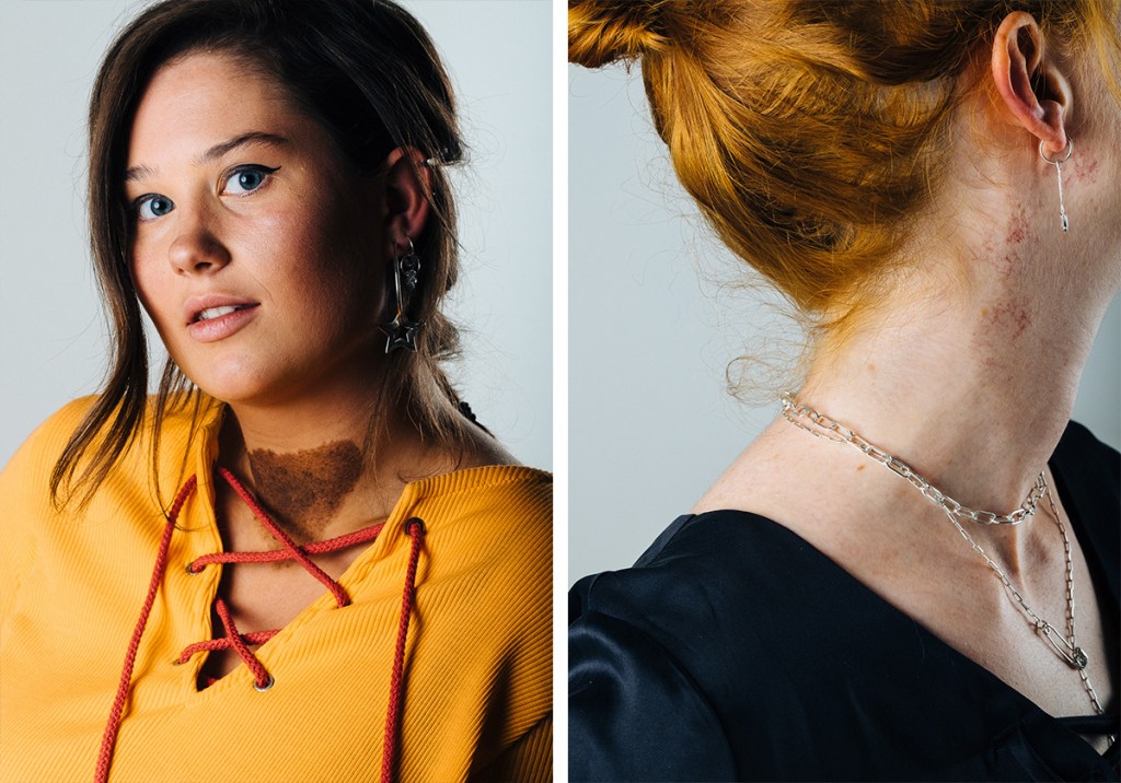 the beauty of pigment: growing up with birthmarks